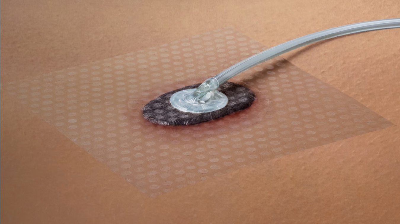 Landingpage - Wondtherapie met negatieve druk (NPWT) · GD Medical