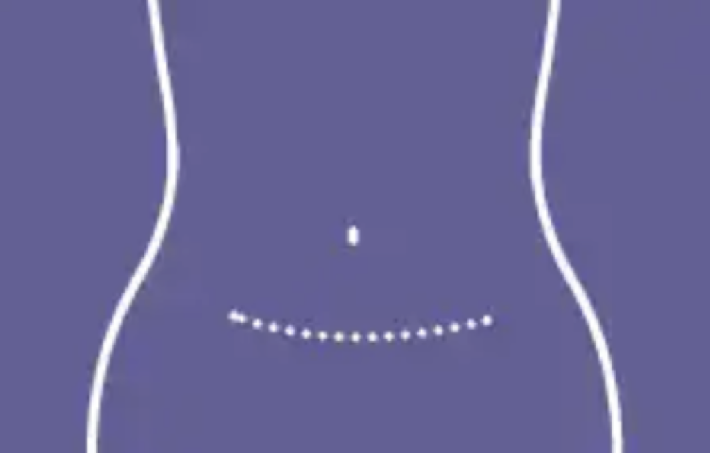 3M™ Prevena™ Therapy · GD Medical