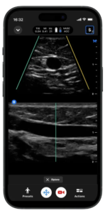 Butterfly POCUS systems · GD Medical
